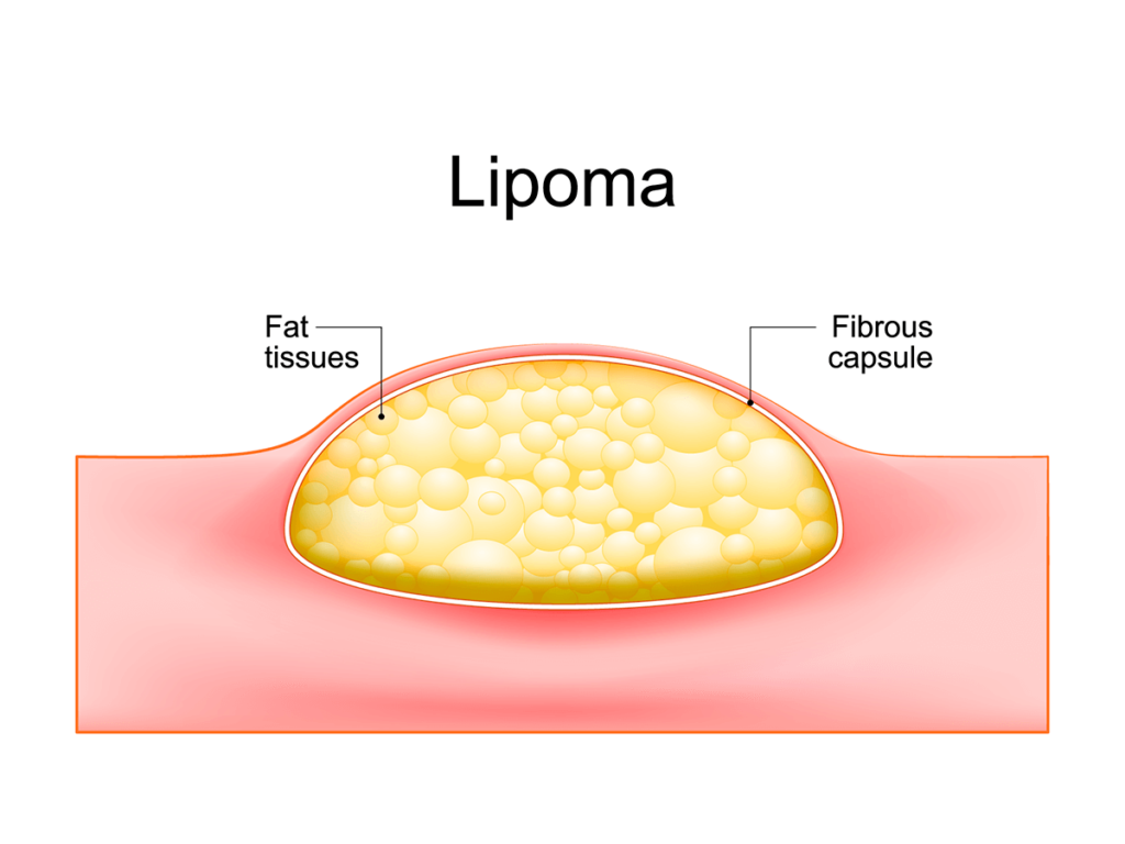 Lipoma, Skin and Fatty Tissue Tumors - Tijuana Surgery Center