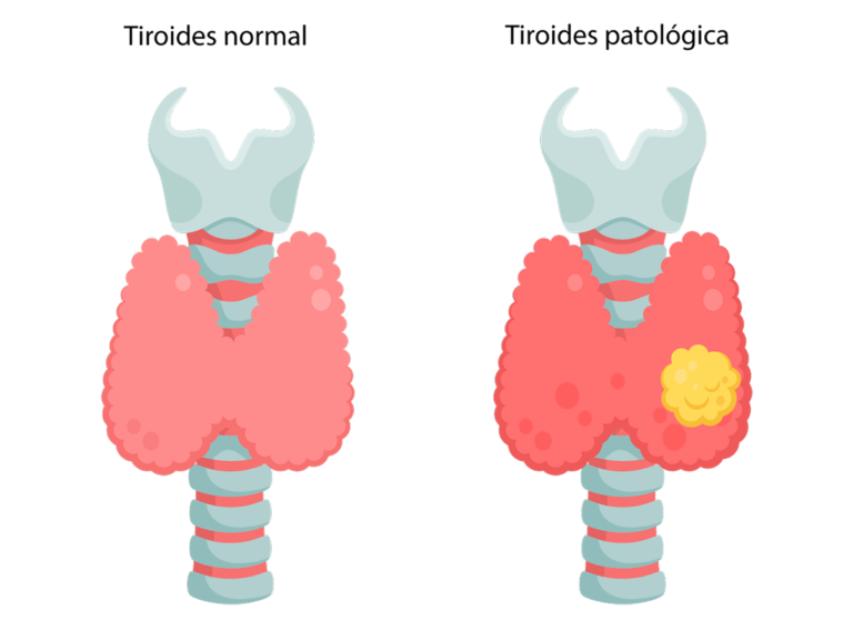 Cirugía de Tiroides y Tumores de Cuello - Tijuana Surgery Center